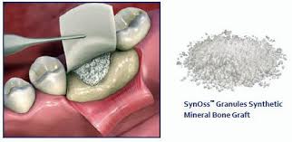 SynOss™ Synthetic Mineral Bone – OsseoDent™