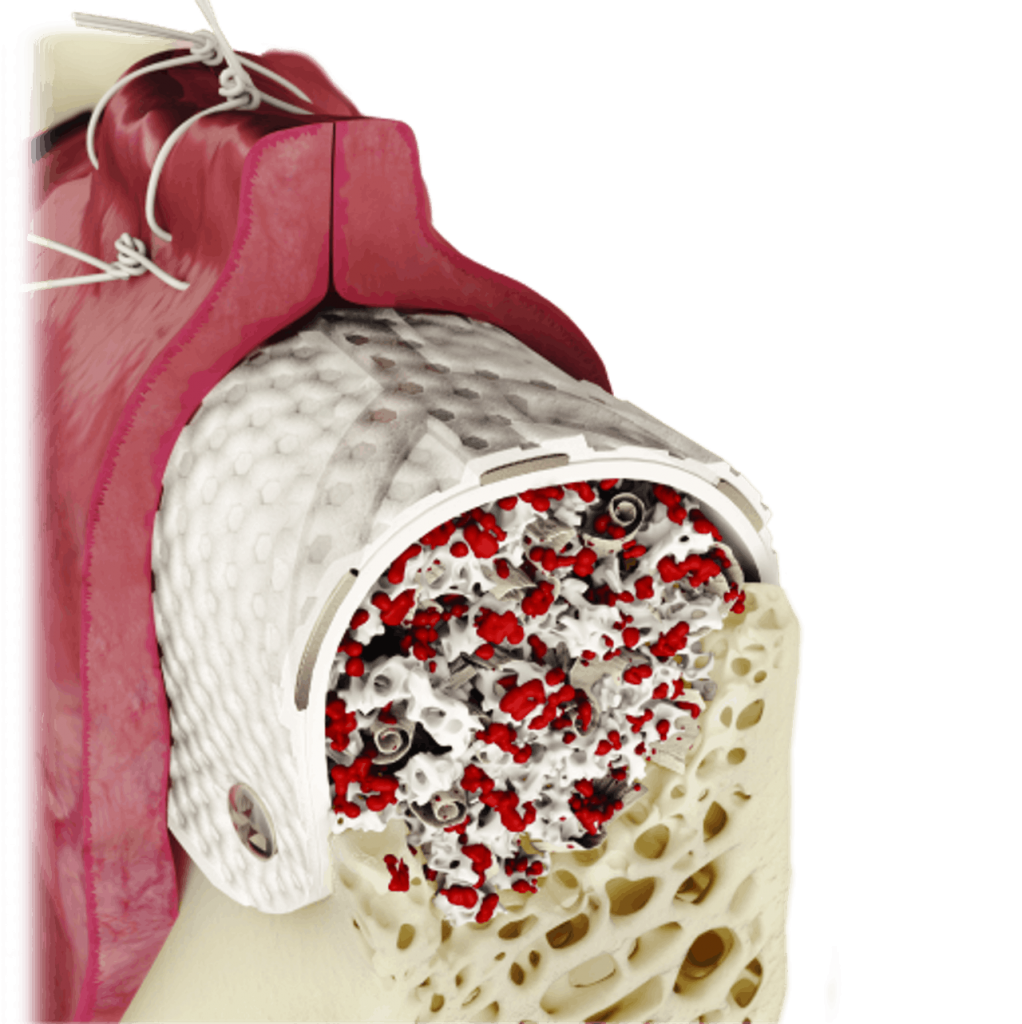 Cytoplast® Ti-250 Titanium PTFE Membranes – OsseoDent™